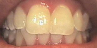 North Adelaide Dental Care - Microabrasion